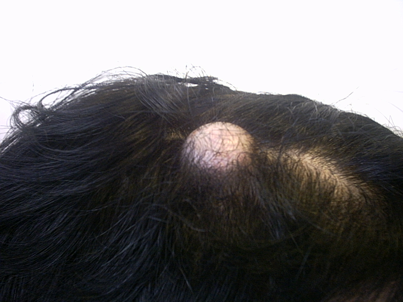 QUISTE SEBÁCEO: UNA INOFENSIVA PERO INESTÉTICA PROTUBERANCIA ~ DR ...