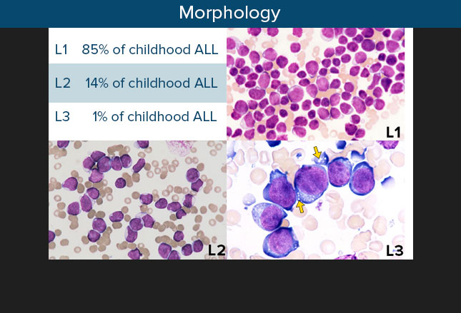 Study Medical Photos: Acute Lymphoblastic Leukemia