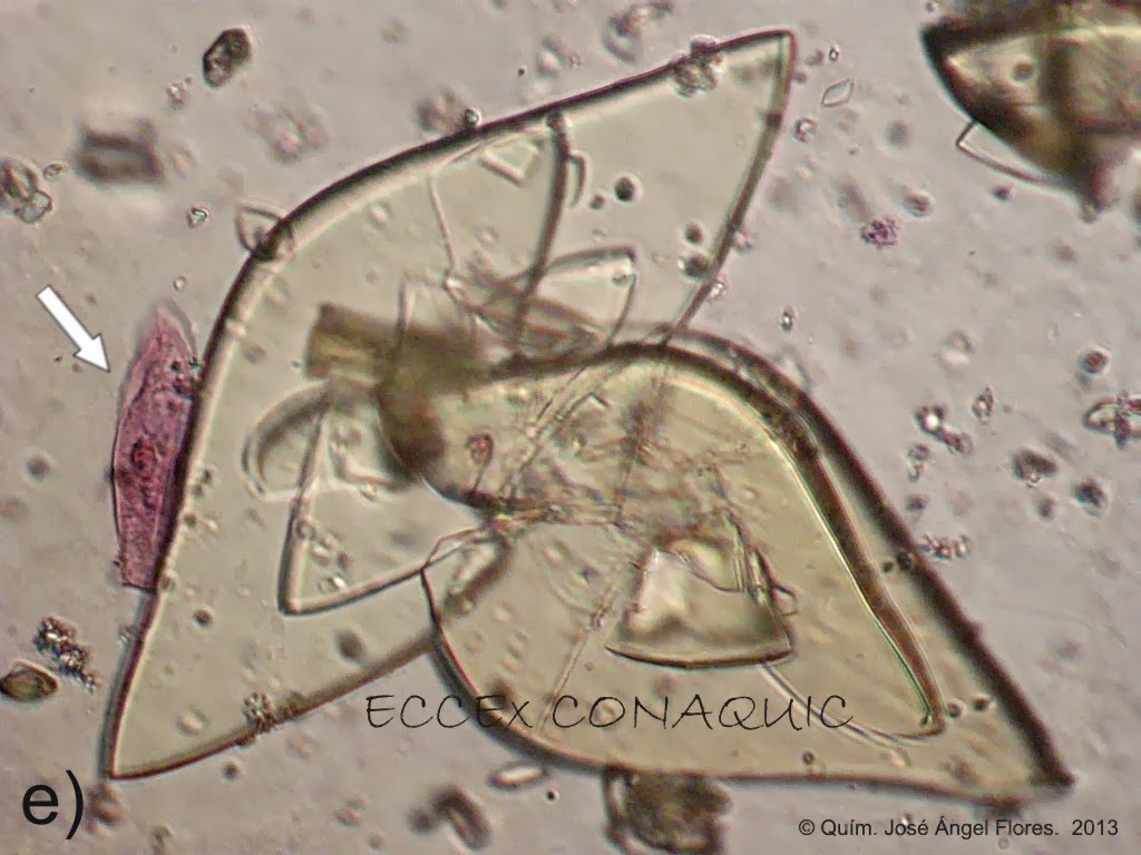 Caso UR-diciembre-13 (Enfoque: cristaluria)