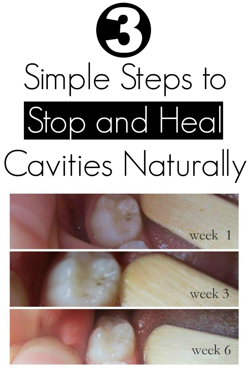 3 Simple Steps to Stop and Heal Cavities Naturally