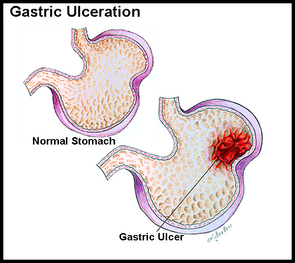 Gastric Ulcer Pictures (Part 2)