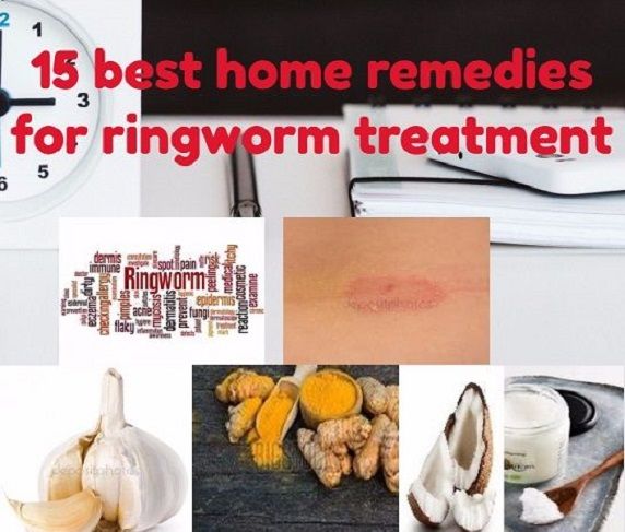 15 best home remedies for ringworm treatment - Top Natural Healthcare