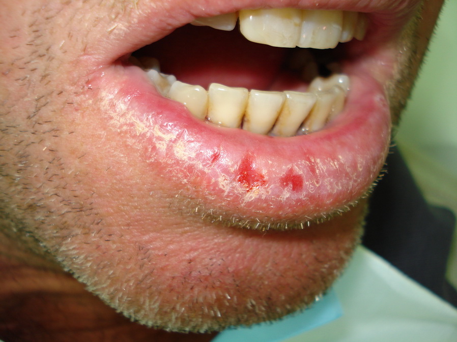 Dermatology For Dentists and Dental Students: Lips
