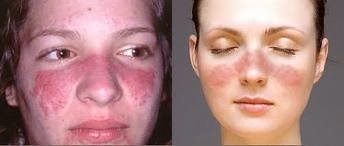 Cara mengobati penyakit lupus ~ Pantangan dan Makanan Sehat