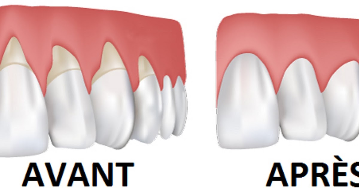 Traiter la récession gingivale Avec ces remèdes maison | Santé Astuce