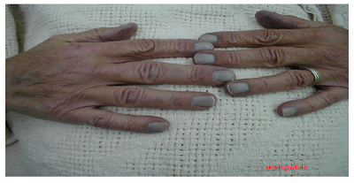 Luxury 40 of Cyanotic Nail Beds | freesislos