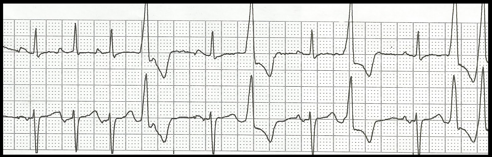 Float Nurse: Practice EKG Rhythm Strips 137