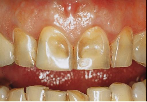 Dentistry lectures for MFDS/MJDF/NBDE/ORE: A note on Jacket crowns ...