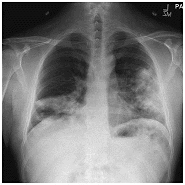 Neumonia: SEGÚN ASPECTO ANATOMICO O PATOLOGICO DEL PULMON