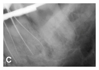 SUHASIS ONLINE: Four-Rooted Mandibular First Molar with an Unusual ...