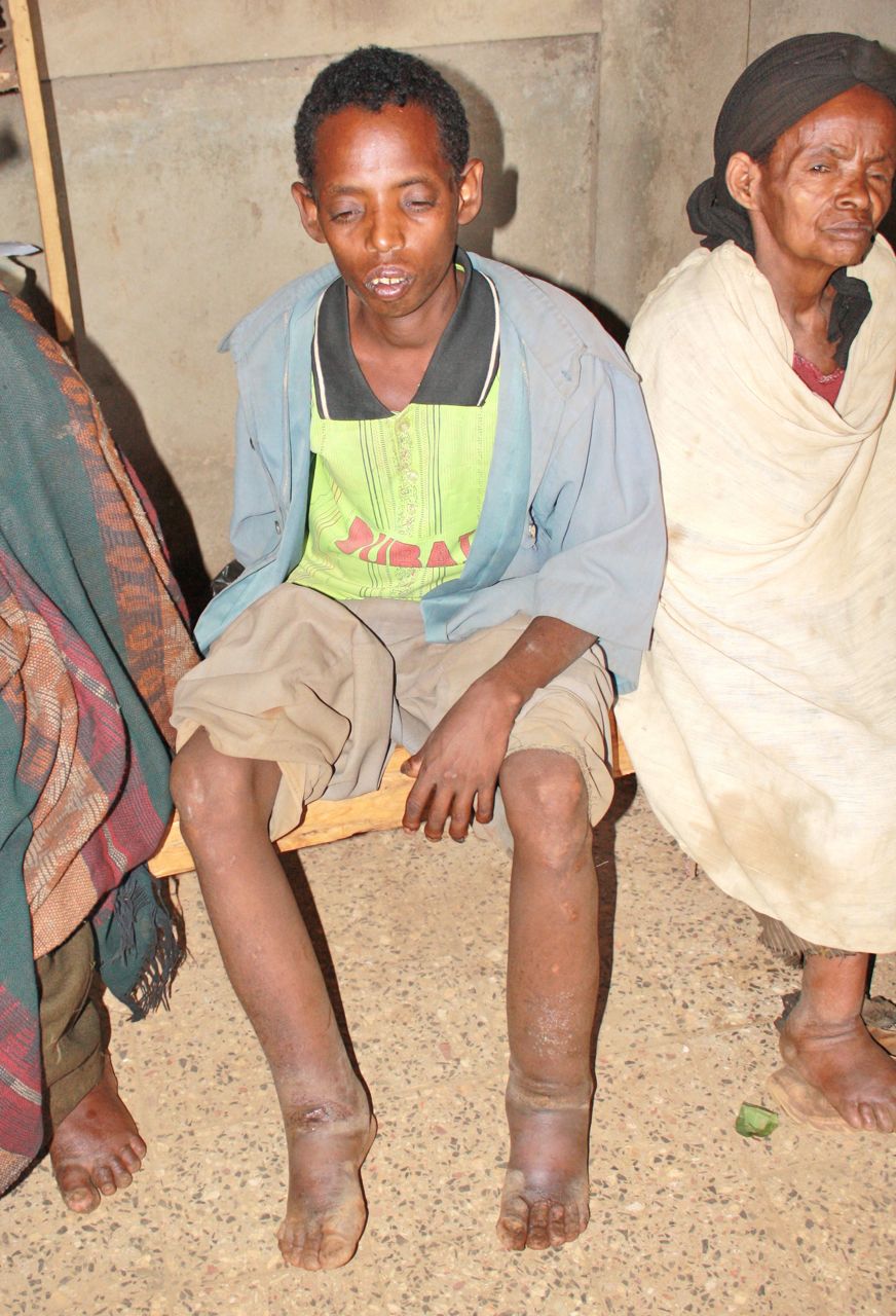 The Mossy Foot News Blog: Visit to the Mossy Foot Gununo Clinic by ...