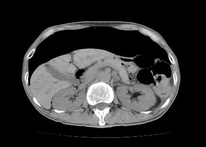 For Better Life..: Bowel perforation during Colonoscopy