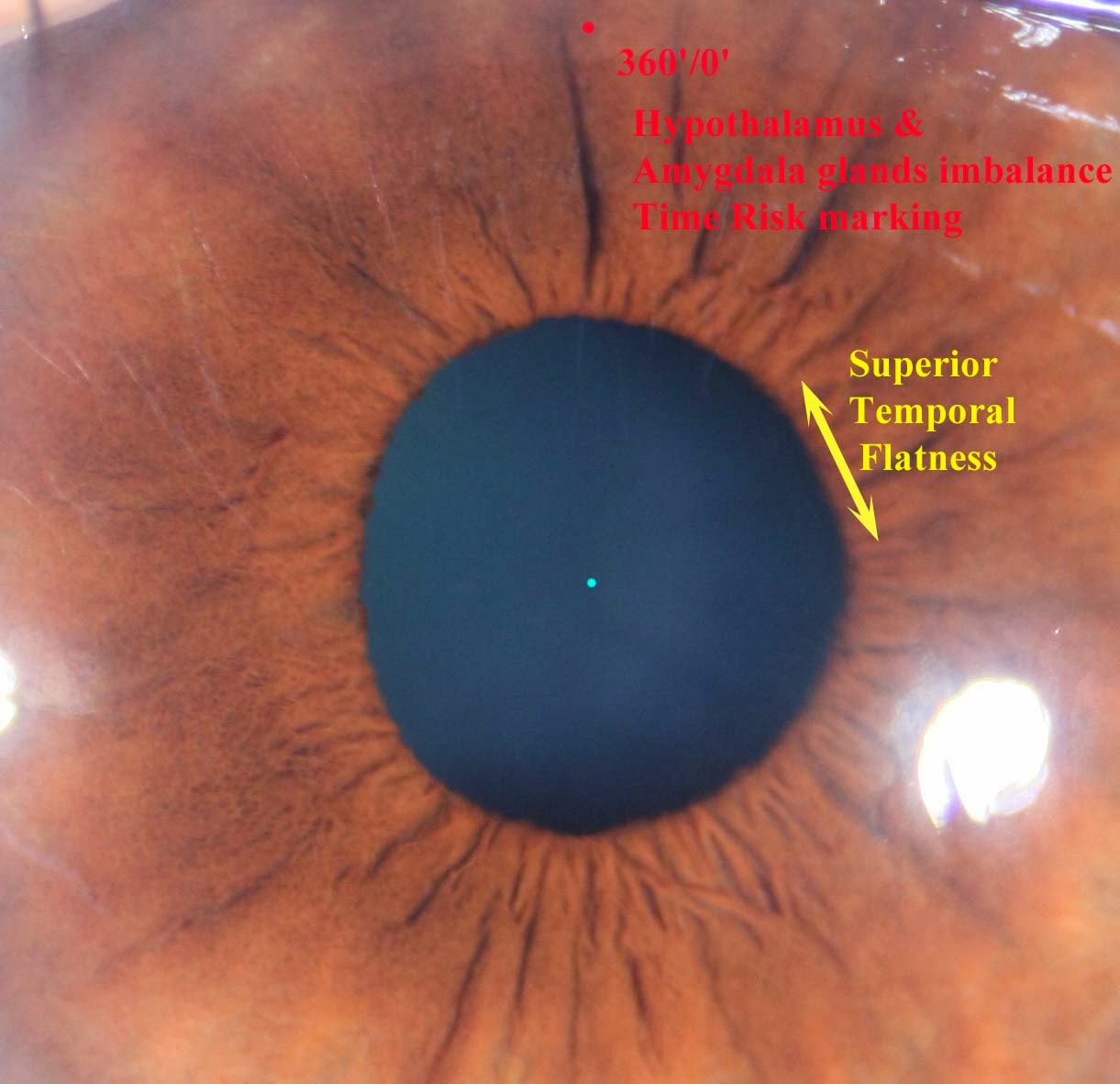 Modern & Multidimensional Iridology: Radial Furrow at 360' & Superior ...