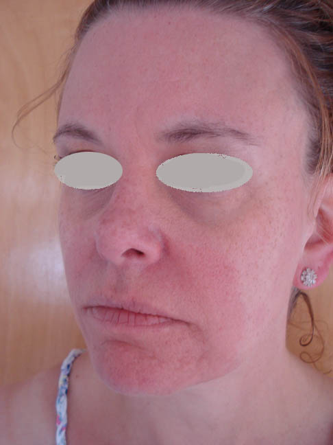 VIRTUAL GRAND ROUNDS IN DERMATOLOGY 2.0: 44 yo woman with facial erythema