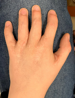 Symbrachydactyly- The typical form defined | Congenital Hand and Arm ...