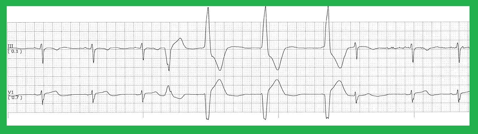 Various Escape Beats