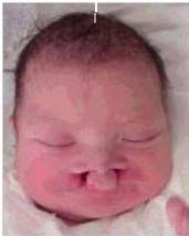 Rennen voor de de actie "Operatie Glimlach: hier en daar!'. : Wat is ...