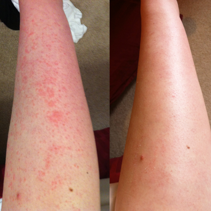 Life With Baby Weber: Surviving PUPPPS