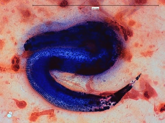 Fun With Microbiology (What's Buggin' You?): Strongyloides stercoralis ...