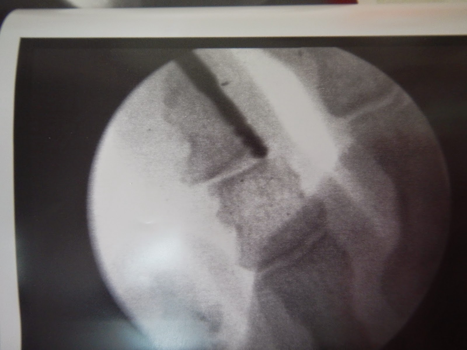 Podo Basas al Día: Condilectomía. Heloma interdigital. Ojo de gallo ...