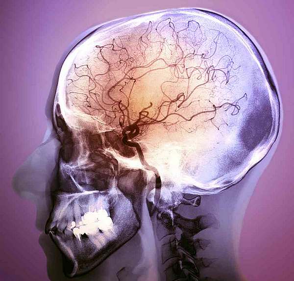 Riesgo de apoplejías - Longevidad, Salud