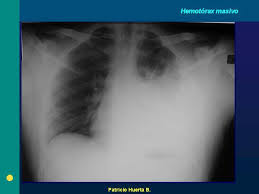 Semiología Quirúrgica Dra. Leroux R.: Examen de Tórax
