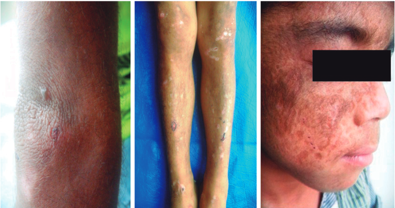 Porfiria Eritropoyética Congénita