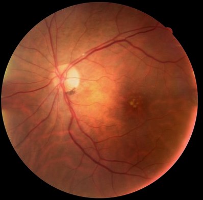 Diagnose My Retinal Photograph - Eyedolatry