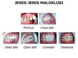 Jenis-Jenis Mal Oklusi