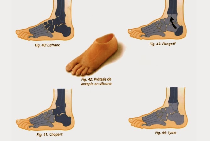 Rascunhos de Fisioterapia: AMPUTAÇÕES, ÓRTESES E PRÓTESES