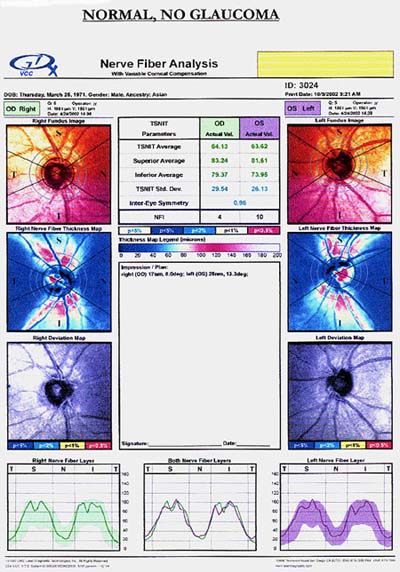 Warna Warni: GDX Glaucoma Test