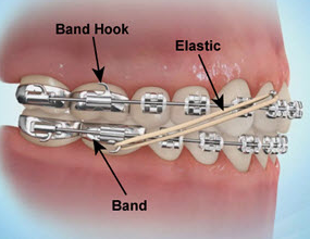 Life As Kim: 7 Months with Braces...