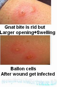 Best How to get rid of gnat bites? ~ Best Homemade Gnat Traps and Gnat ...