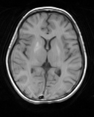 Basal Ganglia T1 Hyperintensity-MRI - Sumer's Radiology Blog