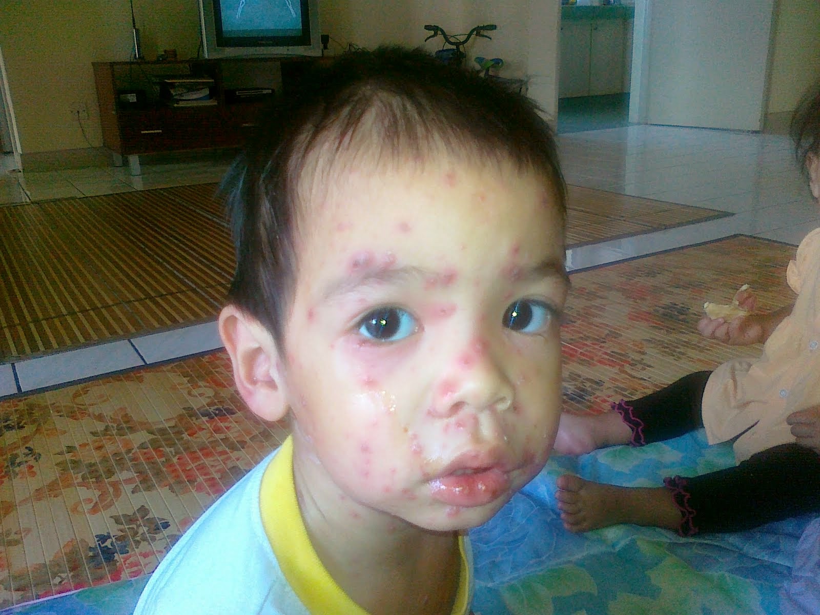 Obat Tradisional Penyakit Campak Pada Anak - Kudokter Herbal Terpercaya