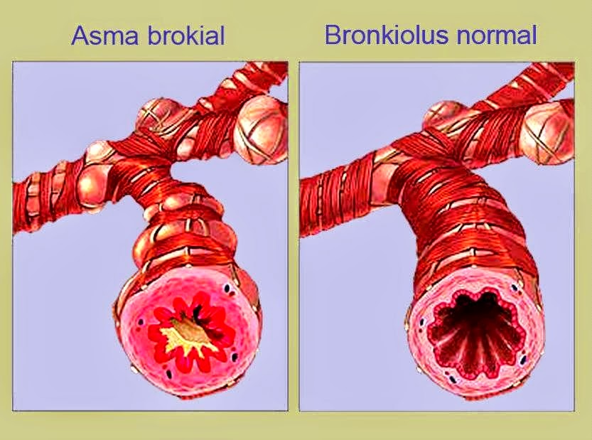 Obat Tradisional Bronkitis | Ku Manggis , Sirsak Untuk Penyakit