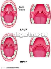 Donna: Diode laser in uvulopalatopharyngoplasty