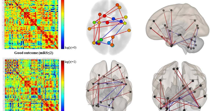Stroke誌：安静時fMRIの機能結合と脳卒中の予後予測 | 脳卒中サバイバのゼンデラ Ⅱ