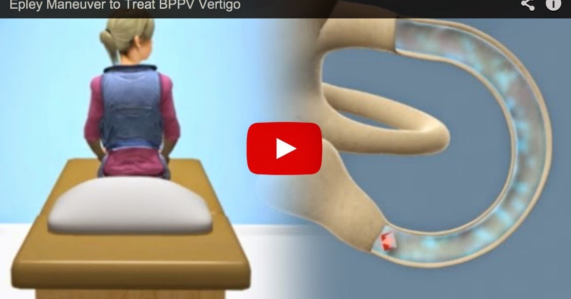 Video of Epley to Treat BPPV (Posterior Canal) | Fauquier ENT Blog