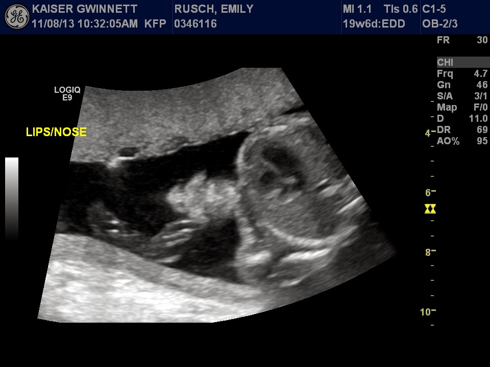 Addison River Rusch: Ultrasound Pictures