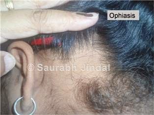Teledermatology for PG entrance: Alopecia Areata