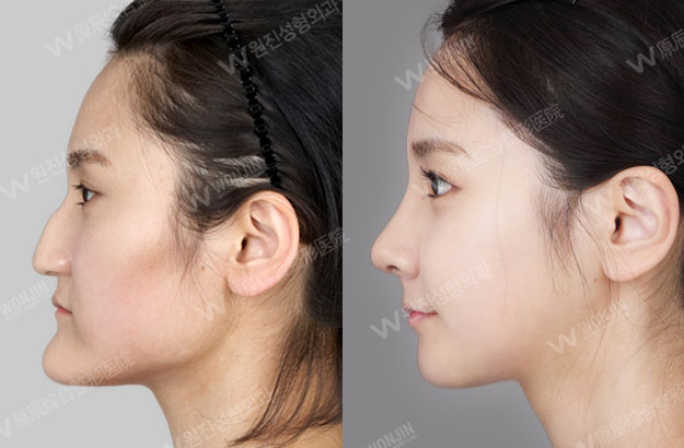 Hidung Panjang dapat menjadi penyebab anda terlihat lebih tua