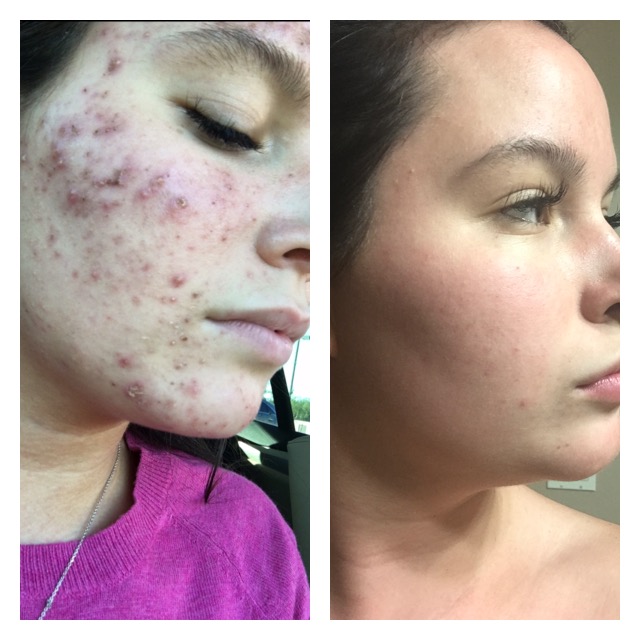 C3 Clinical Corrective Care: Acne