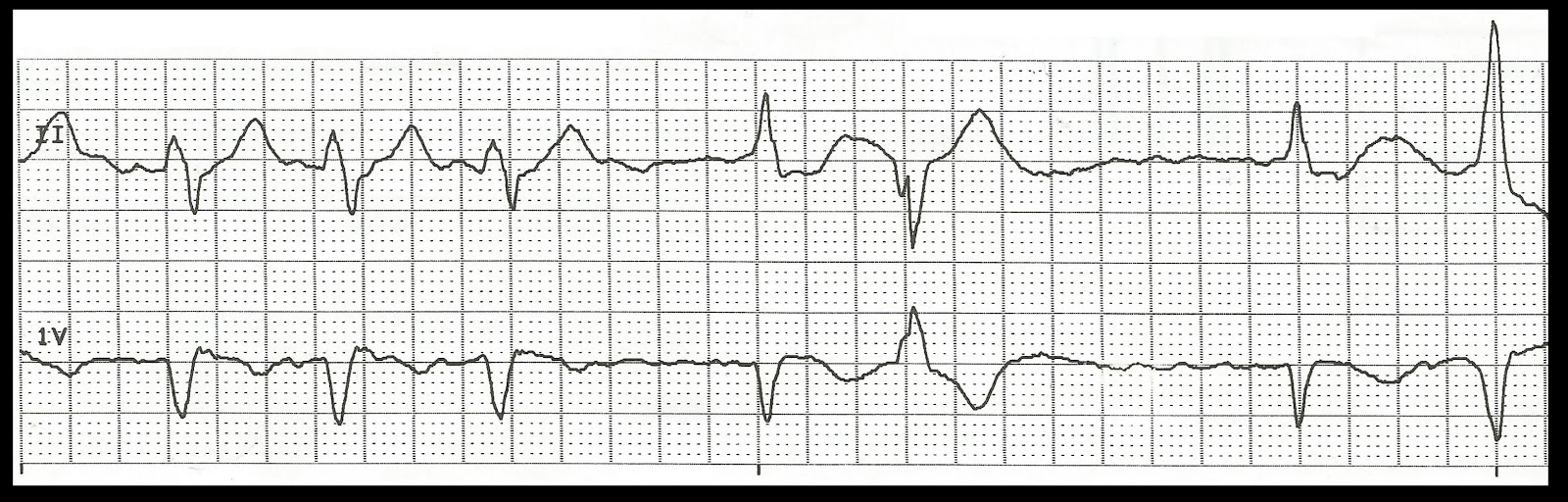 EKG Rhythm Strip Quiz 153