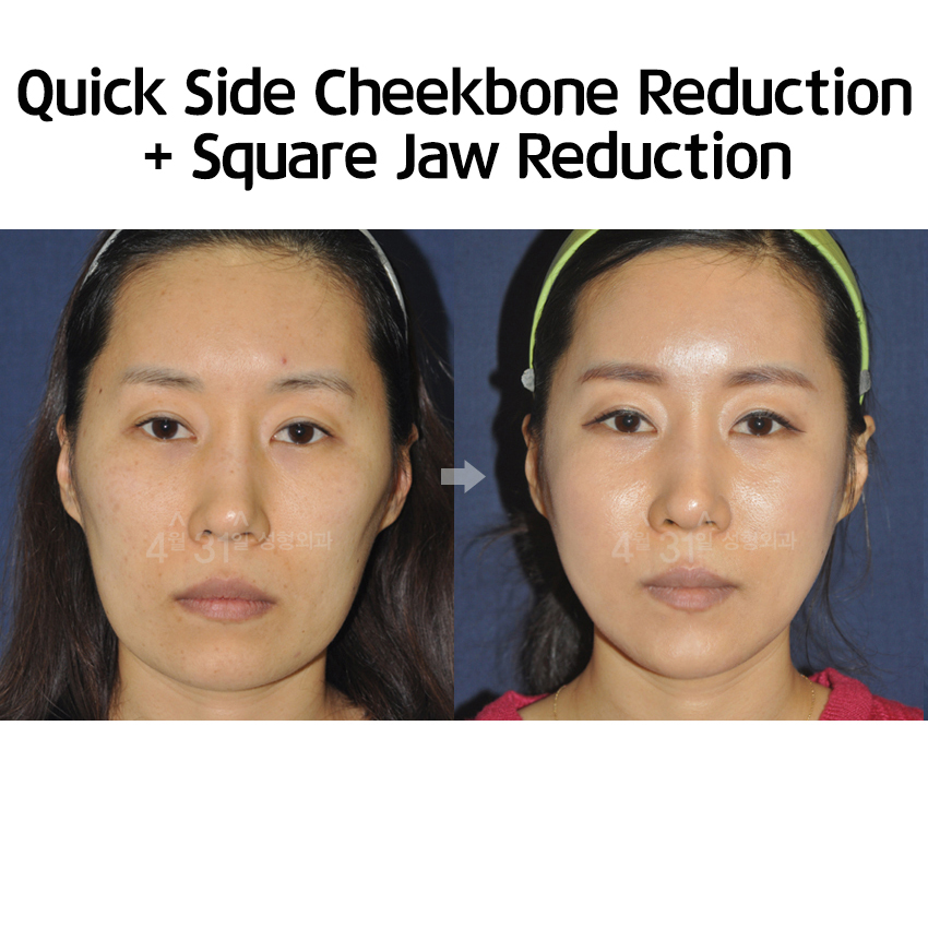 April31 Plastic Surgery Clinic: Quick Side Cheekbone Reduction + Square ...