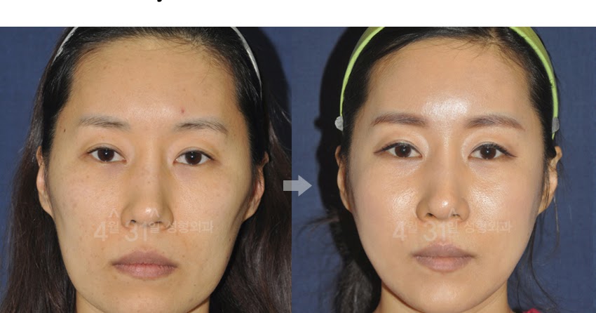 April31 Plastic Surgery Clinic: Quick Side Cheekbone Reduction + Square ...