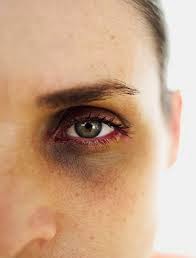 Primeros Auxilios: Cómo tratar un ojo amoratado?