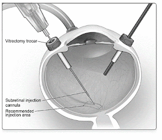 Matheson Optometrists Blog: Nice gives Luxturna the NHS go ahead.
