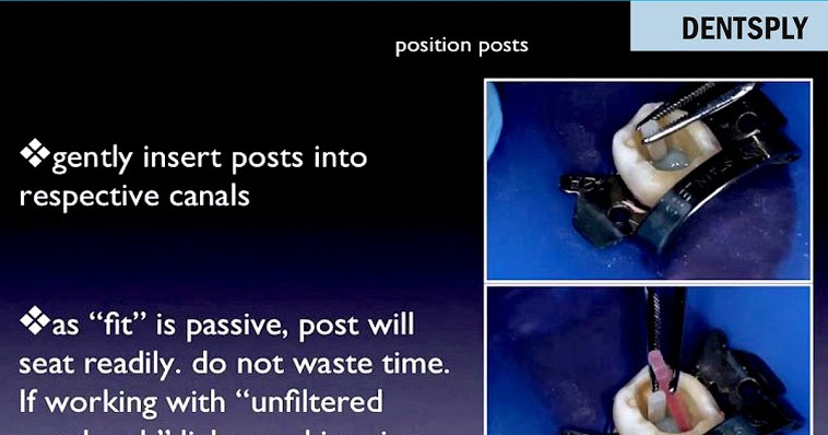 DENTSPLY: Post and Core for Endodontic Restorations - Odonto-Tv