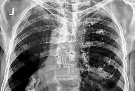 Fieggentrio: Erwtenplantje groeit in longen van een man.